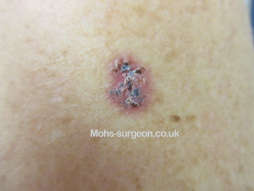 BCC on Leg – Basal Cell Carcinoma Picture | Mr Tehrani – Mohs Surgeon